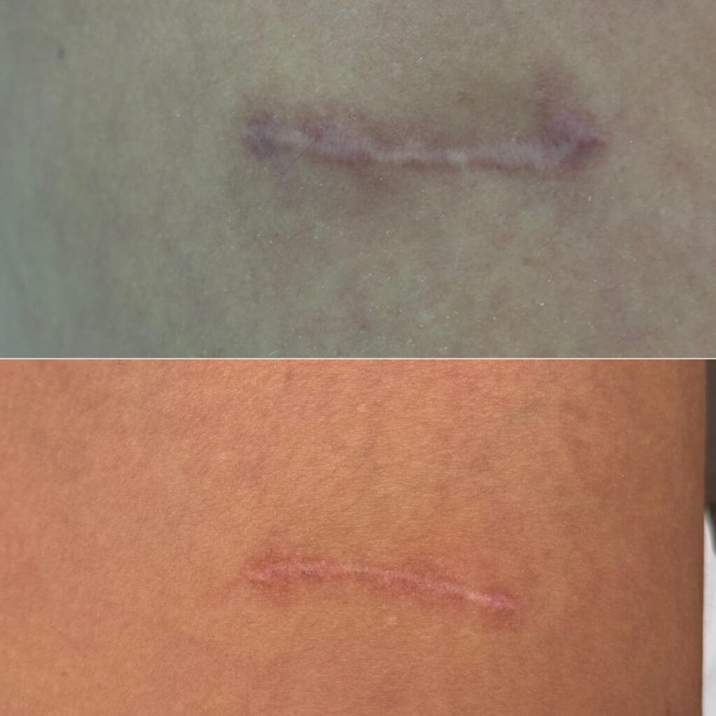Scar Revision – H Gracefully